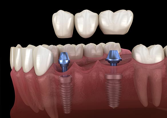 Zubni most Osijek | Dragaš Dental Design